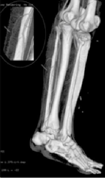 A Course Of The Perforators Up To The Subdermal Plexus Of The Download Scientific Diagram