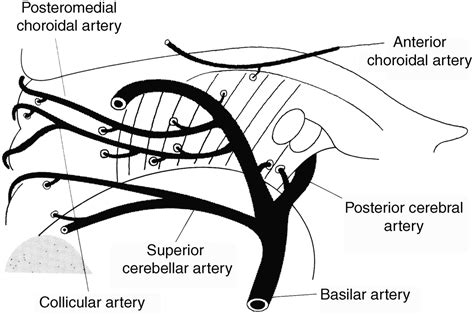 Midbrain Stroke Syndromes Midbrain Stroke Syndromes