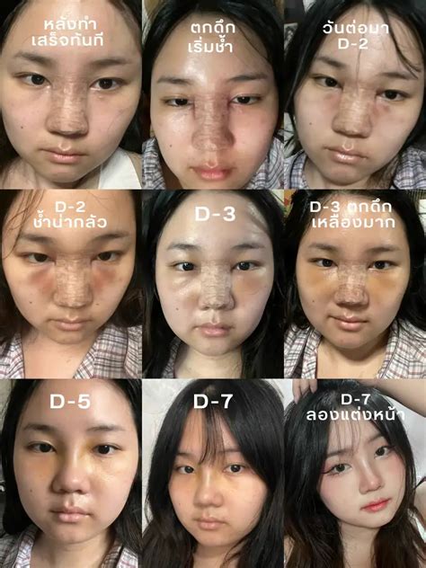 ⌗ รีวิวทำจมูกครั้งแรก 👃🏻 ꒰ เคสเนื้อน้อย ดั้งแหมบ ꒱ No Sponsor แกลเลอ