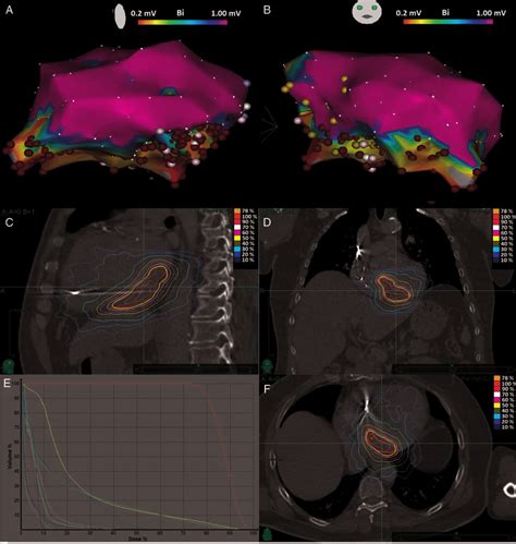Example Of 3d Electroanatomical Mapping And Corresponding Radiosurgical
