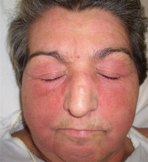 Dermatomyositis Rare Disease Medical Dermatology