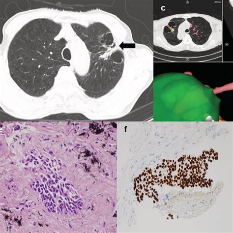The Learning Curve Of Electromagnetic Navigation Bronchoscopy Enb