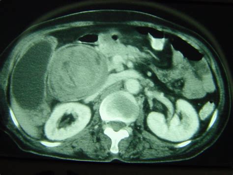 Liver Cholangiohepatitis 2693 Common Bile Duct Intrahepatic Stones 2 Surgery Photos