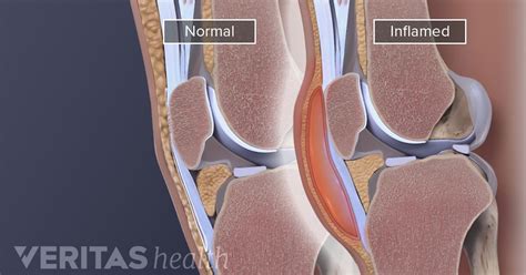 What Causes A Swollen Knee Water On The Knee