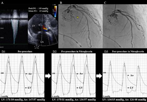 Percutaneous Alcohol Septal Ablation A The Left Ventricular Outflow
