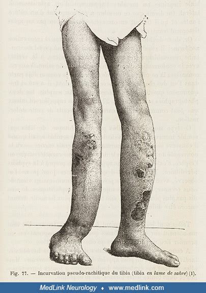 Saber Shin Syphilis Congenital Syphilis