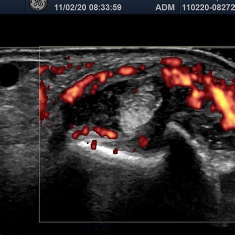Dorsal Longitudinal Scan Of Pip Joint In A Patients With Psa Download Scientific Diagram