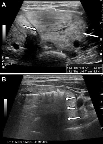 Multinodular Goiter Ultrasound