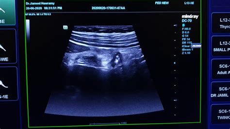 Subhepatic Appendix Youtube