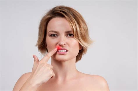 How To Treat Cold Sores And Avoid Complications MOM News Daily