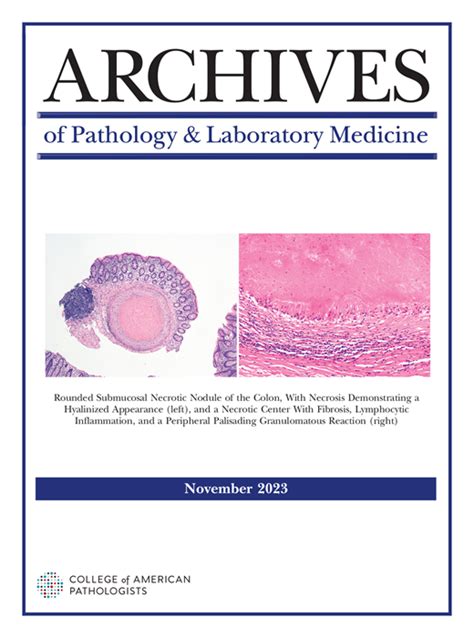 Submucosal Necrotic Nodule Of The Colon An Enigmatic Entity Potentially Related To Anisakis