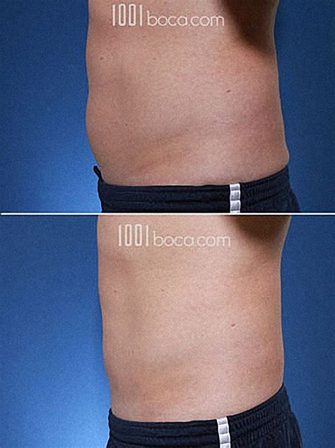 Coolsculpting Men Belly1 Steiger Facial Plastic Surgery Boca Raton