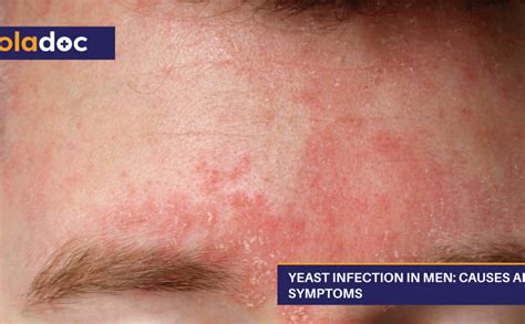 Yeast Infection Yeast Infection Anus Yeast Infection