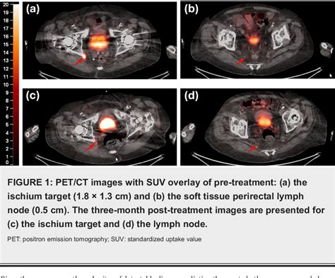 Figure 1 From Adaptive Driven Ct Simulation Free Soft Tissue