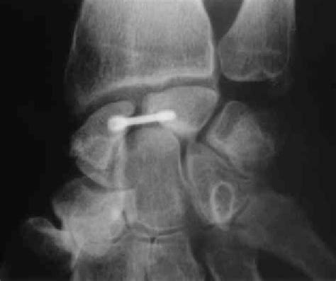Figure 1 From Isolated Carpal Scaphoid Dislocation Semantic Scholar