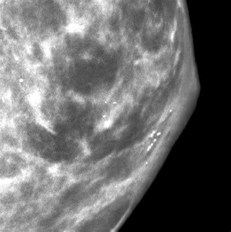 Pathology Outlines Microcalcifications