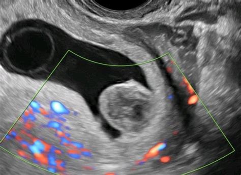 Medical Ultrasound Academy On Linkedin Chorionic Bump