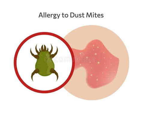 Dust Mites And Parasites Insecticide Vector Illustration Design Stock
