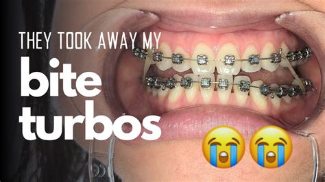 What Are Turbos For Braces At Rodolfo Freeman Blog