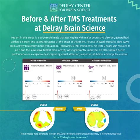 Tms Resuls Delray Brain Science