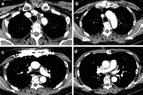 Postoperative Axial View Chest Ct Download Scientific Diagram