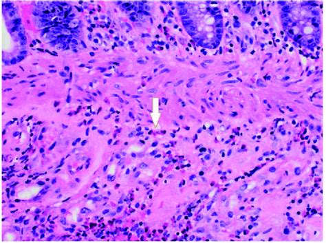 Biopsies Showed Friable Mucosa With Ulcerations Not Pictured And