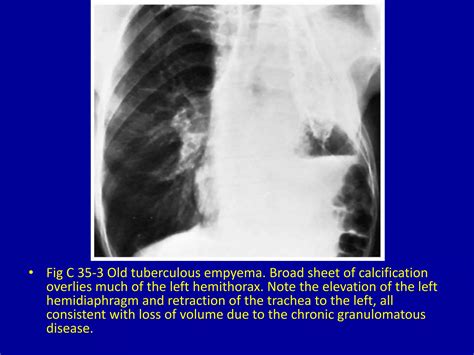35 Pleural Calcification Ppt