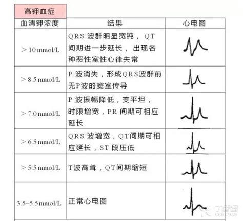 鉴别高钾血症与低钾血症 一张表格就够了