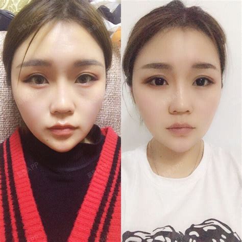 脸溶脂针前后对比照片 溶脂针前后对比照片 伤感说说吧
