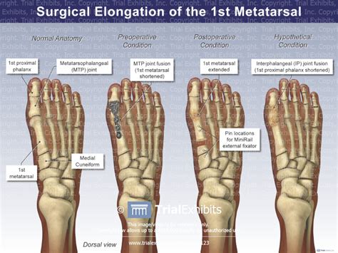 Surgical Elongation Of The 1st Metatarsal Trialquest Inc