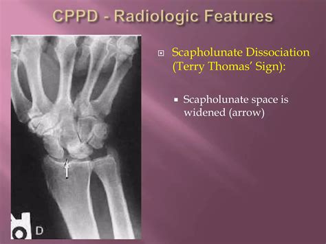 Metabolic Scurvy Gout Cppd Fluorosis Sayid Ppt Metabolic Scurvy Gout Cppd Fluorosis Sayid Ppt