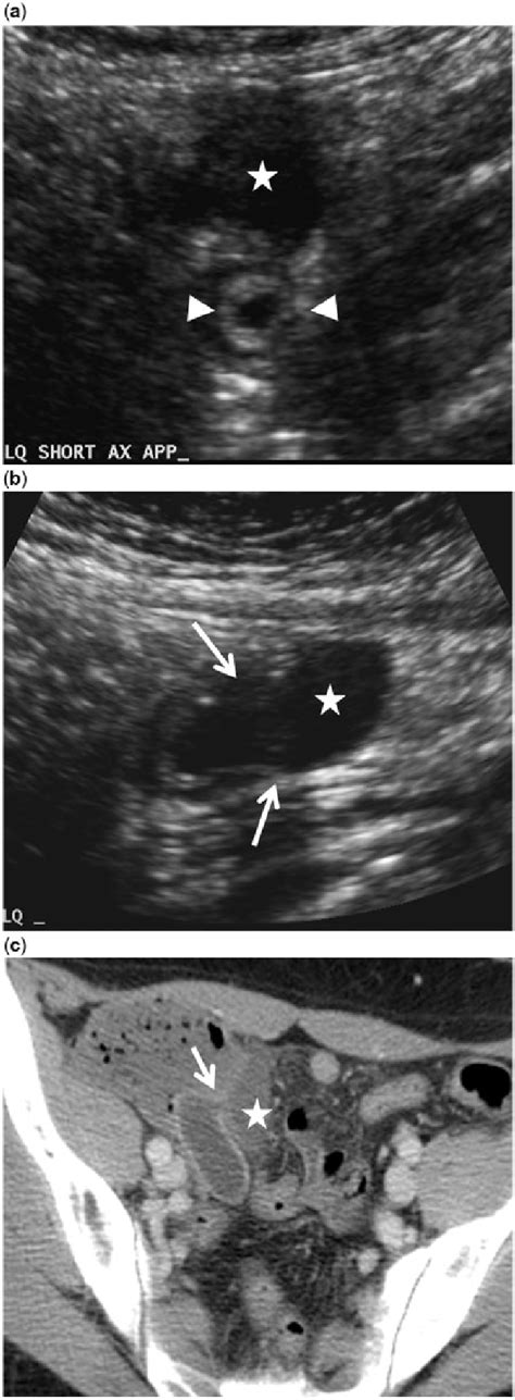 A 50 Year Old Woman With Mucinous Neoplasm Of The Appendix And Download Scientific Diagram