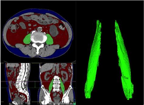 Three Dimensional Volumetry Of The Psoas Major Muscle Using The Synapse