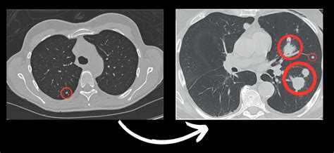 Detecting And Predicting Relapse Of Nsclc Using Artificial Intelligence