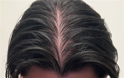 Scalp Visibility Issue Rmalehairadvice