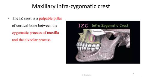 Infra Zygomatic Crest Implants Izc Pptx