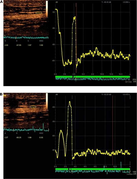 Timesignal Intensity Curves Of Plaque Yellow Area And Curve At