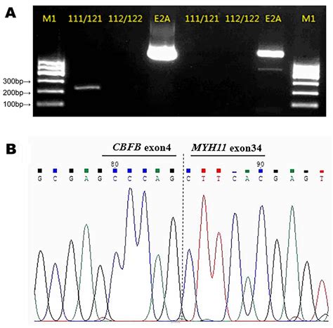 Rare Type I Cbfβmyh11 Fusion Transcript In Primary Acute Myeloid