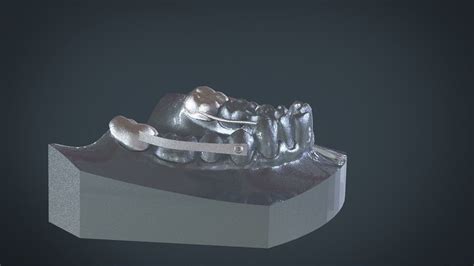 Digital Telescopic Herbst Appliance 3d Model 3d Printable Cgtrader