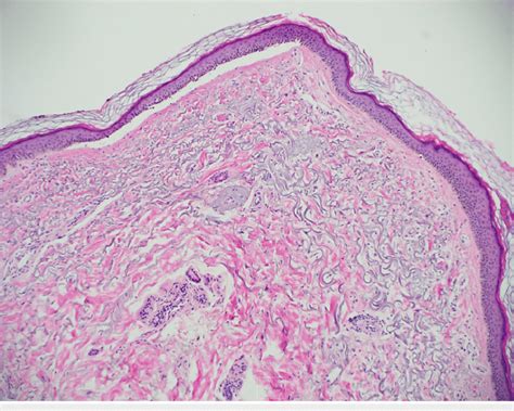 Biopsy Showing Thick Homogeneous Deposition Of Igg Iga And Fibrinogen