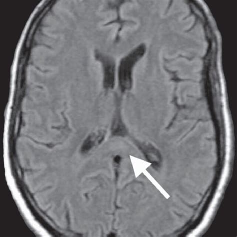 mri of the brain showing t2 fluid attenuated inversion recovery signal download scientific