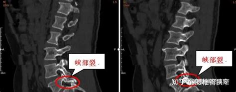 腰椎峡部裂到底如何有效治疗 知乎