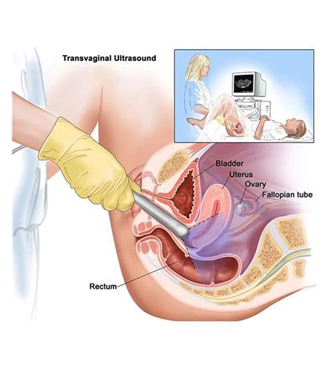 Transvaginal Ultrasound During Pregnancy A Complete Guide