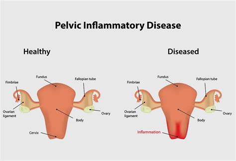 Pelvic Inflammatory Disease Ultrasound