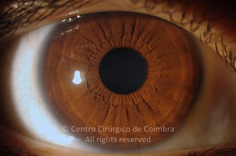 Caso Clínico 1 Atlas Rl Eye
