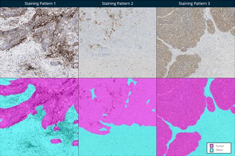 Nsclc Ihc Tumor Tissue Detection Indica Labs