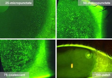 Table 2 From A Novel Scale For Describing Corneal Staining Semantic Scholar Table 2 From A Novel Scale For Describing Corneal Staining Semantic Scholar