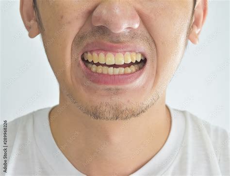 Yellow Teeth From Coffee