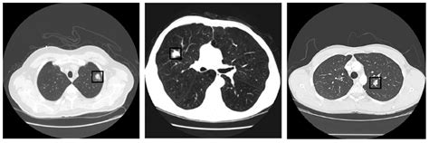 sensors free full text automated lung nodule detection and