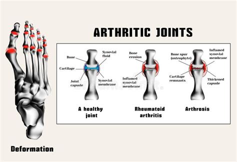 Synovial Joint Structure Stock Vector Illustration Of Disease 22042874